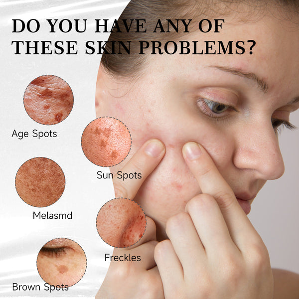 aobenz Dark Spot Remover for Face & Body | Advanced Corrector Serum fo ...